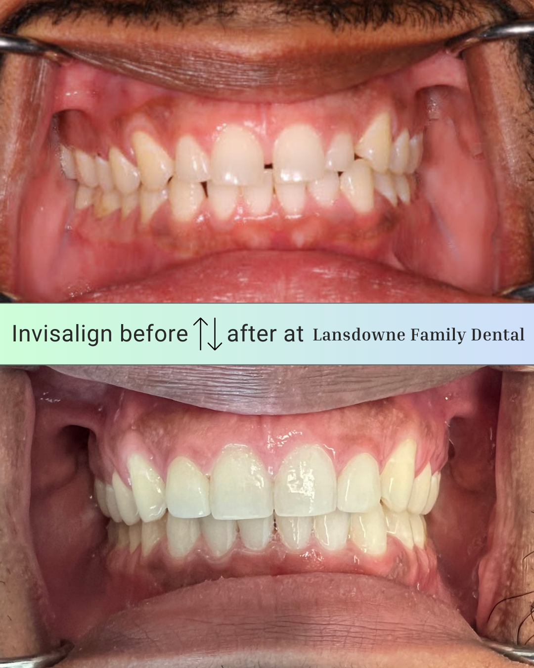 Invisalign Before And After