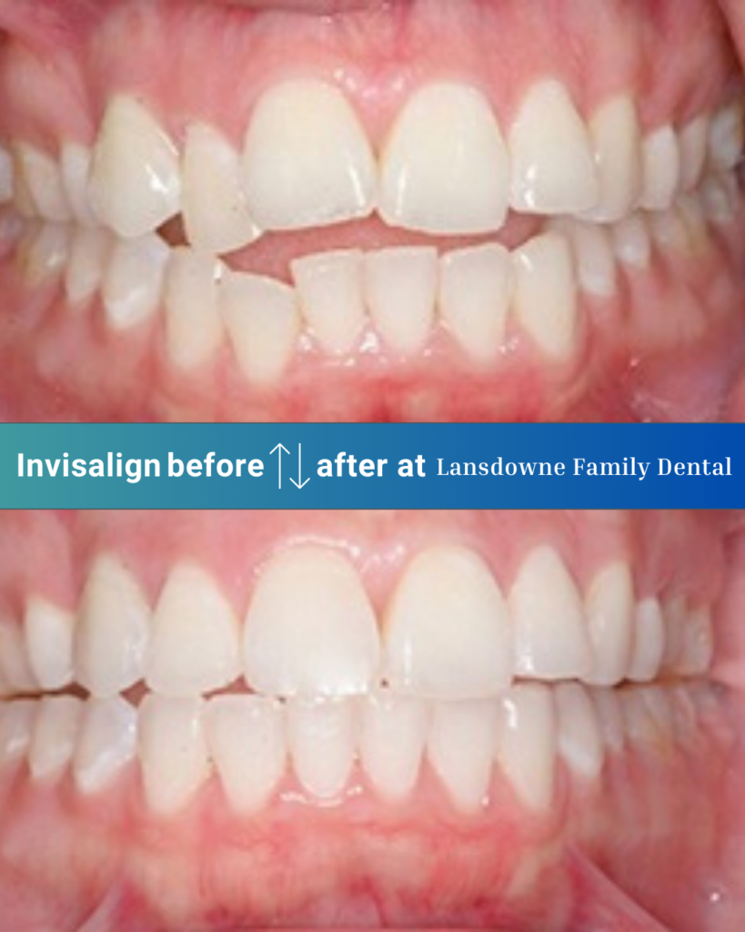 Best Invisalign Dentist In Leesburg, Ashburn, Lansdowne, VA